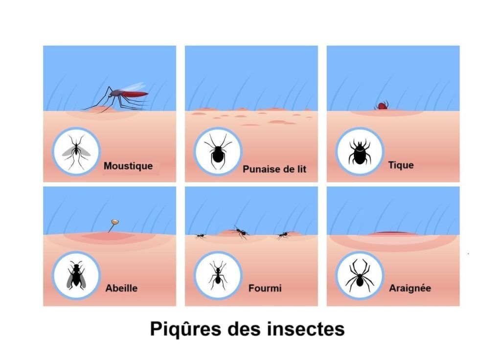 Comment reconnaître les piqûres de punaises de lit : traitement et photos