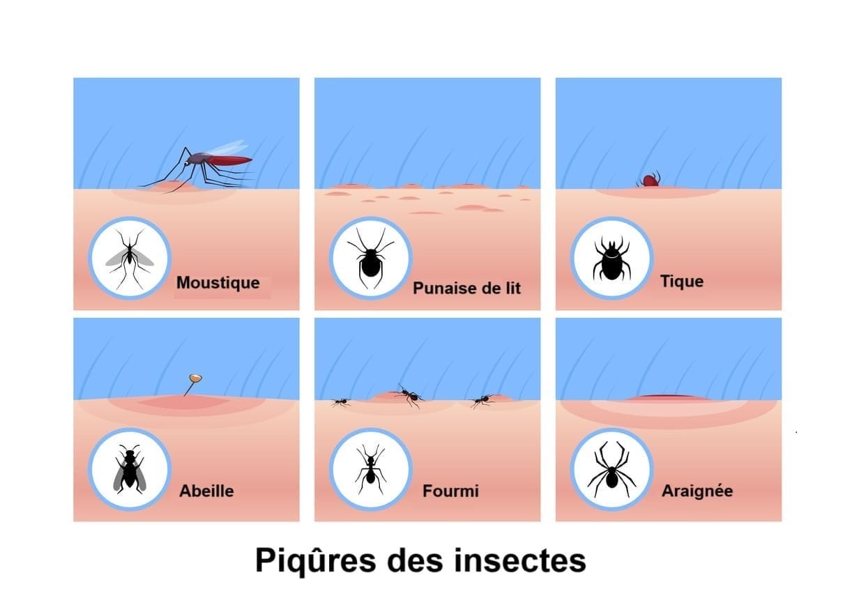 Comment reconnaître les piqûres de punaises de lit : traitement et photos